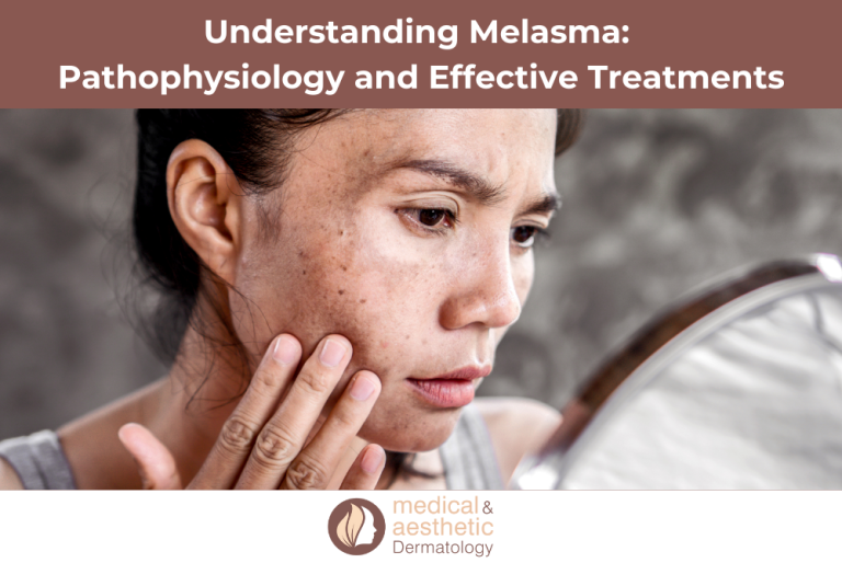 Understanding Melasma: Pathophysiology and Effective Treatments ...